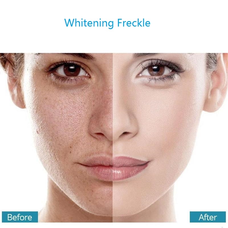 Freckle Cream Remove Dark Spots Anti Freckle Cream Fade Pigmentation ...